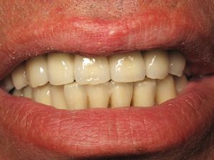 Fixed and mobile prosthetics - Ordinacija dentalne medicine Subotić